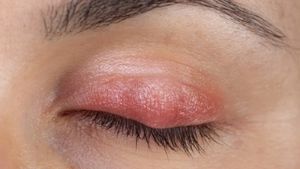 Trachom: Ursachen, Symptome und Behandlung | Brille24 DE